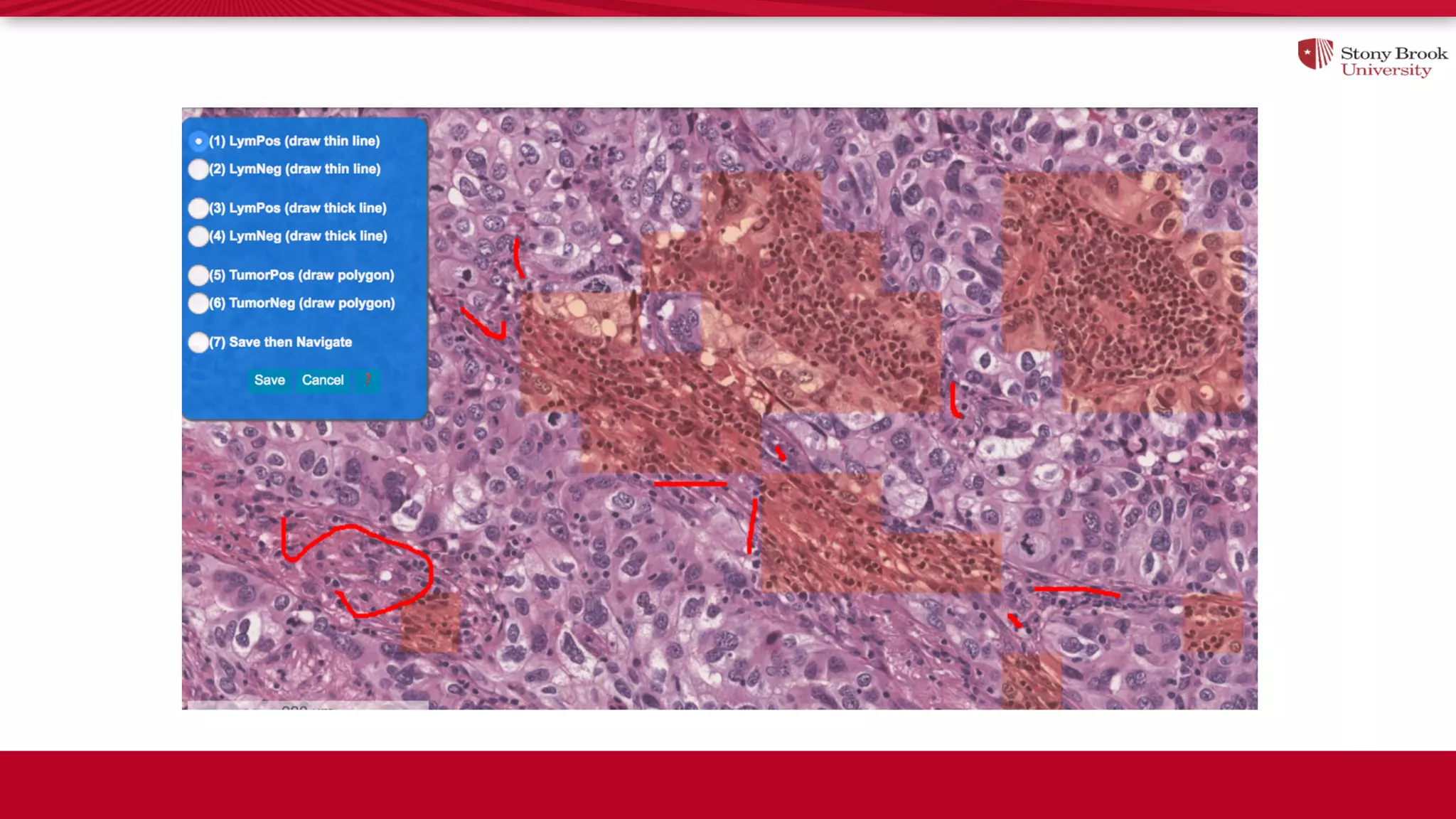 Digital Pathology: Precision Medicine, Deep Learning and Computer Aided ...