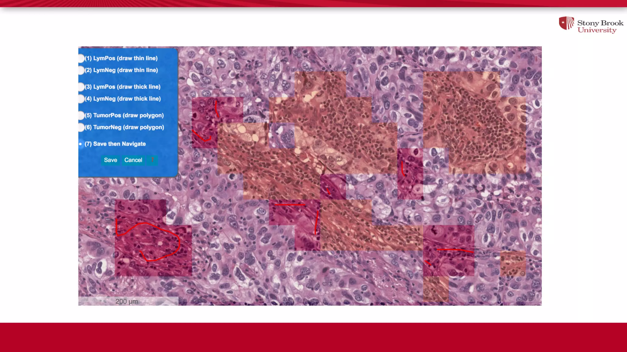 Digital Pathology: Precision Medicine, Deep Learning and Computer Aided ...