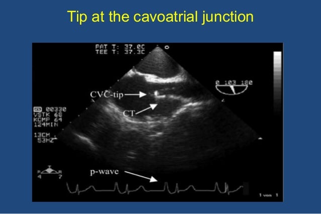 TARTING YOUR VENOUS ACCESS PROGRAM