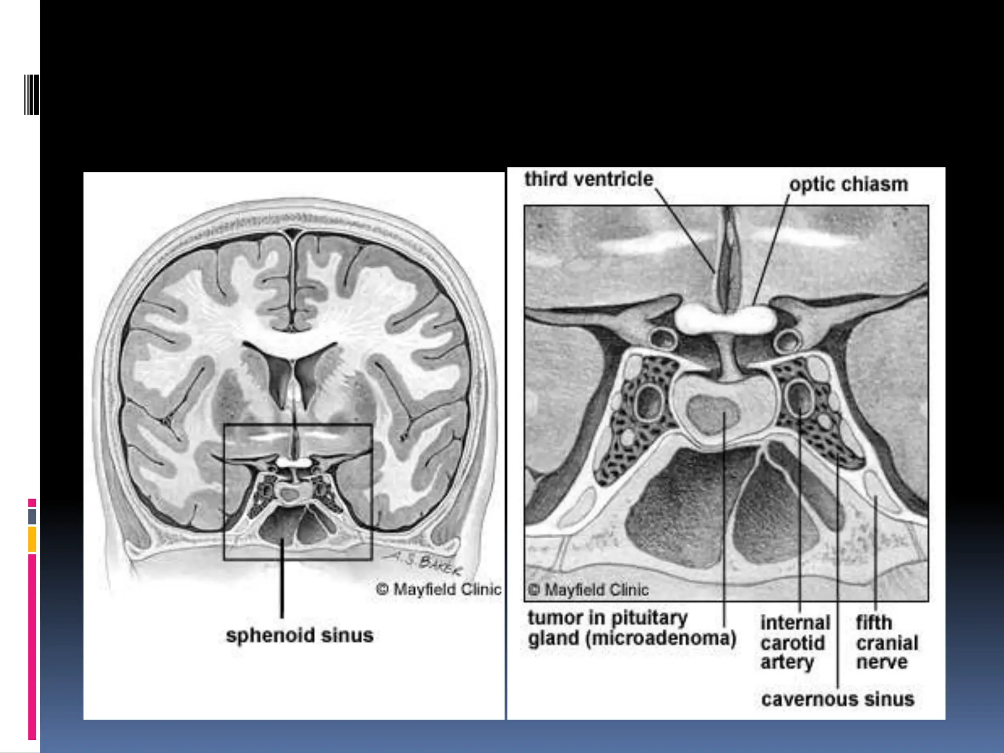 PITUITARY gland anatomy and physiology with clinical presentations of ...
