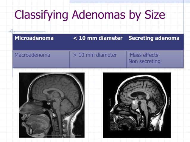 Pituitary adenomas: Clinical, neuro-ophthalmic, radiological evaluation ...