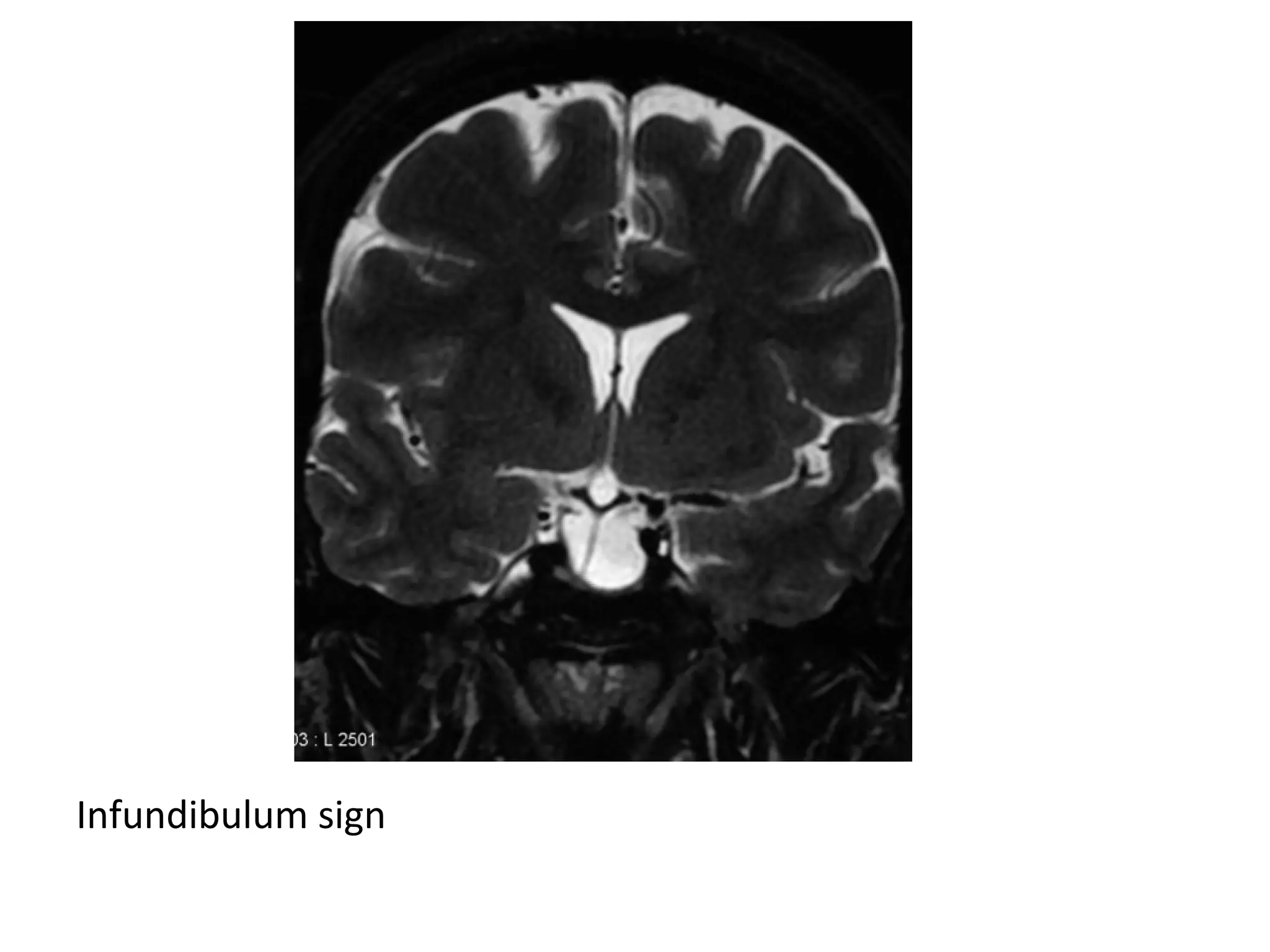 Diagnostic Imaging of the Pituitary Gland | PPT
