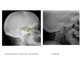 Diagnostic Imaging of the Pituitary Gland | PPT