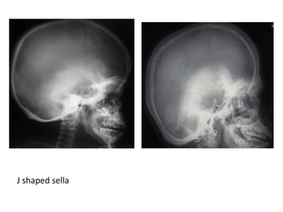 Diagnostic Imaging of the Pituitary Gland | PPT
