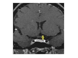 Diagnostic Imaging of the Pituitary Gland | PPT