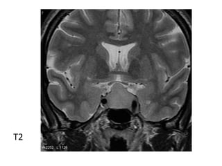 Diagnostic Imaging of the Pituitary Gland | PPT