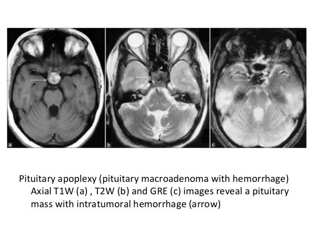 Diagnostic Imaging of the Pituitary Gland