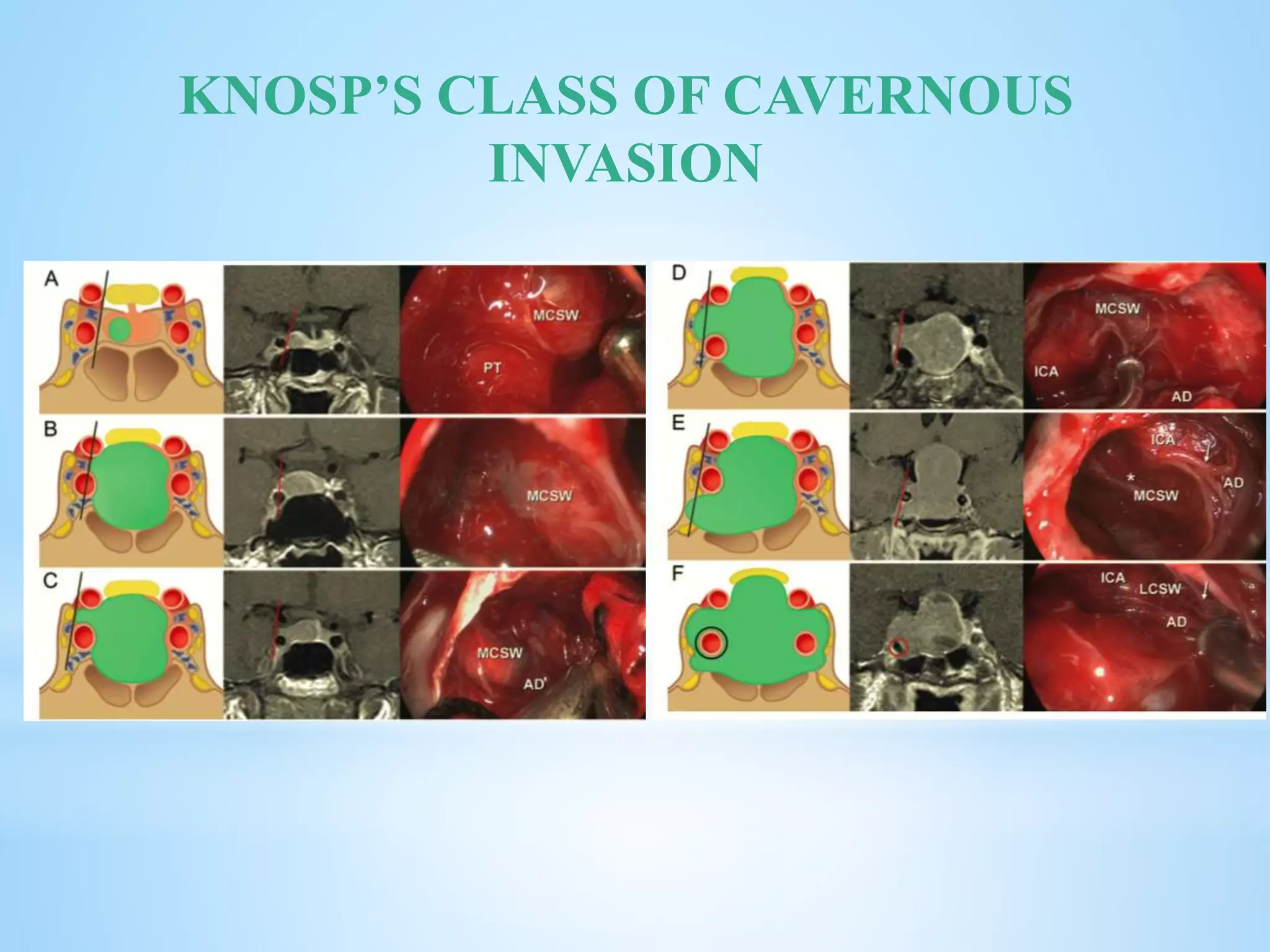 NEUROSURGICAL TENETS OF PITUITARY GLAND | PPTX