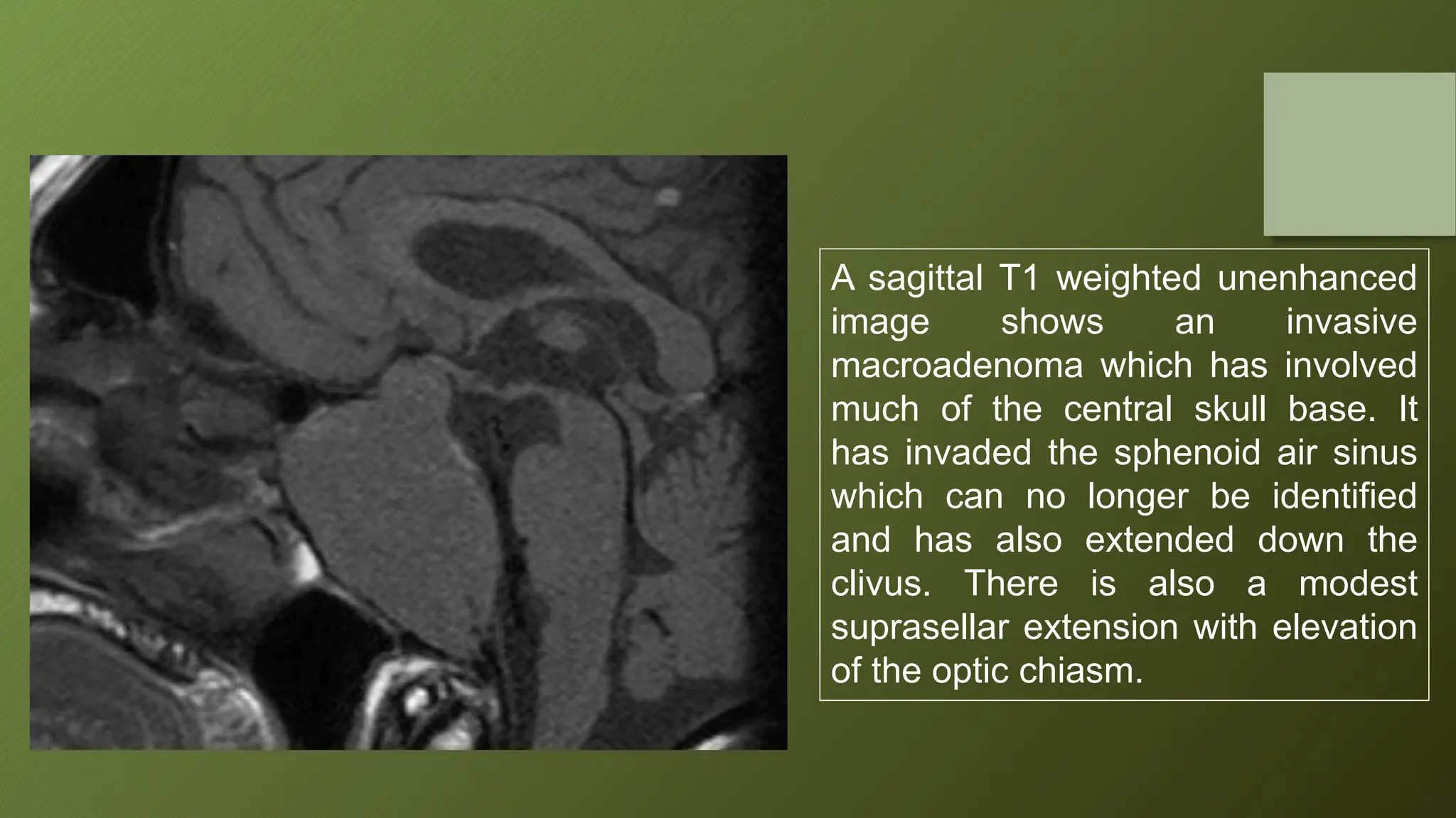 Pituitary Gland Mri Pptx 3940