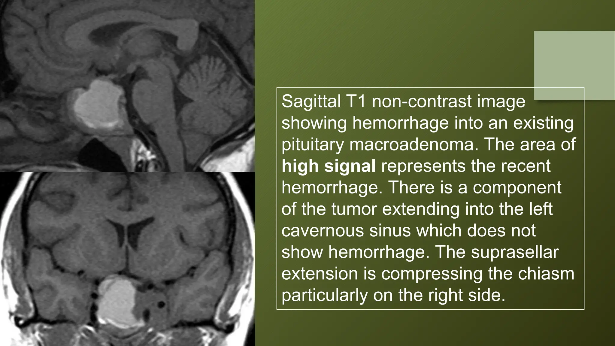 Pituitary gland MRI | PPTX