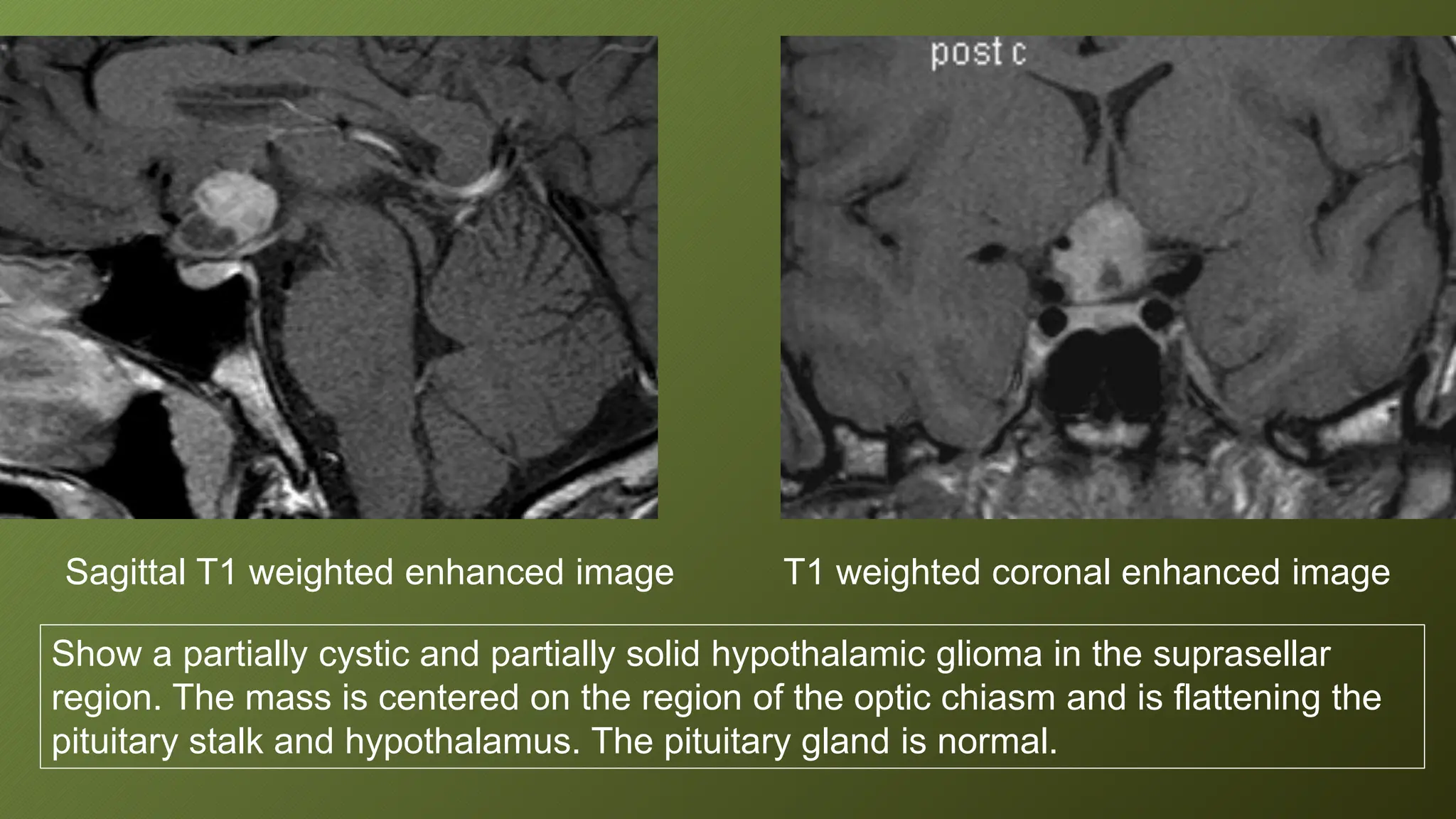 Pituitary gland MRI | PPTX