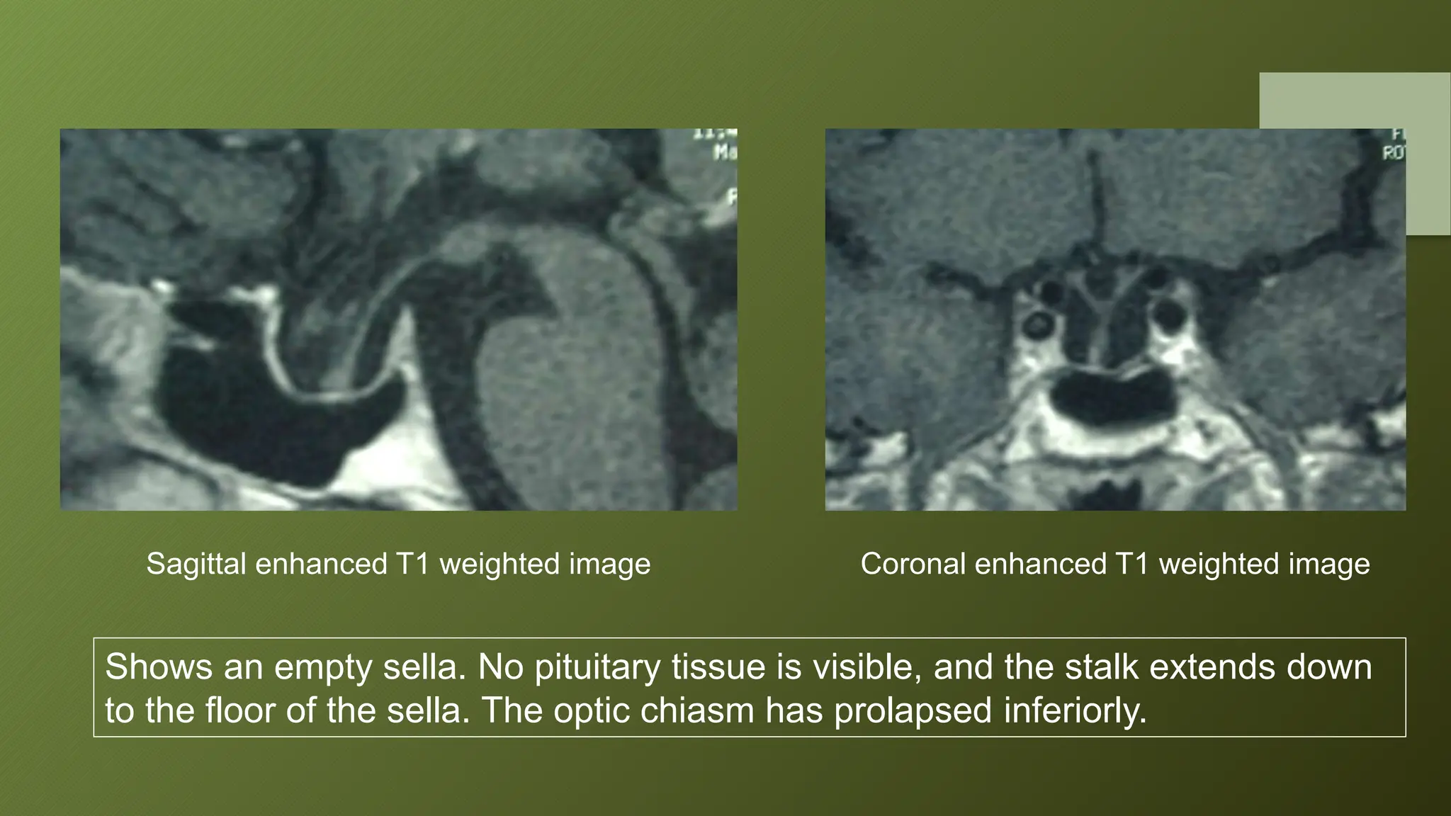 Pituitary Gland Mri Pptx 0917