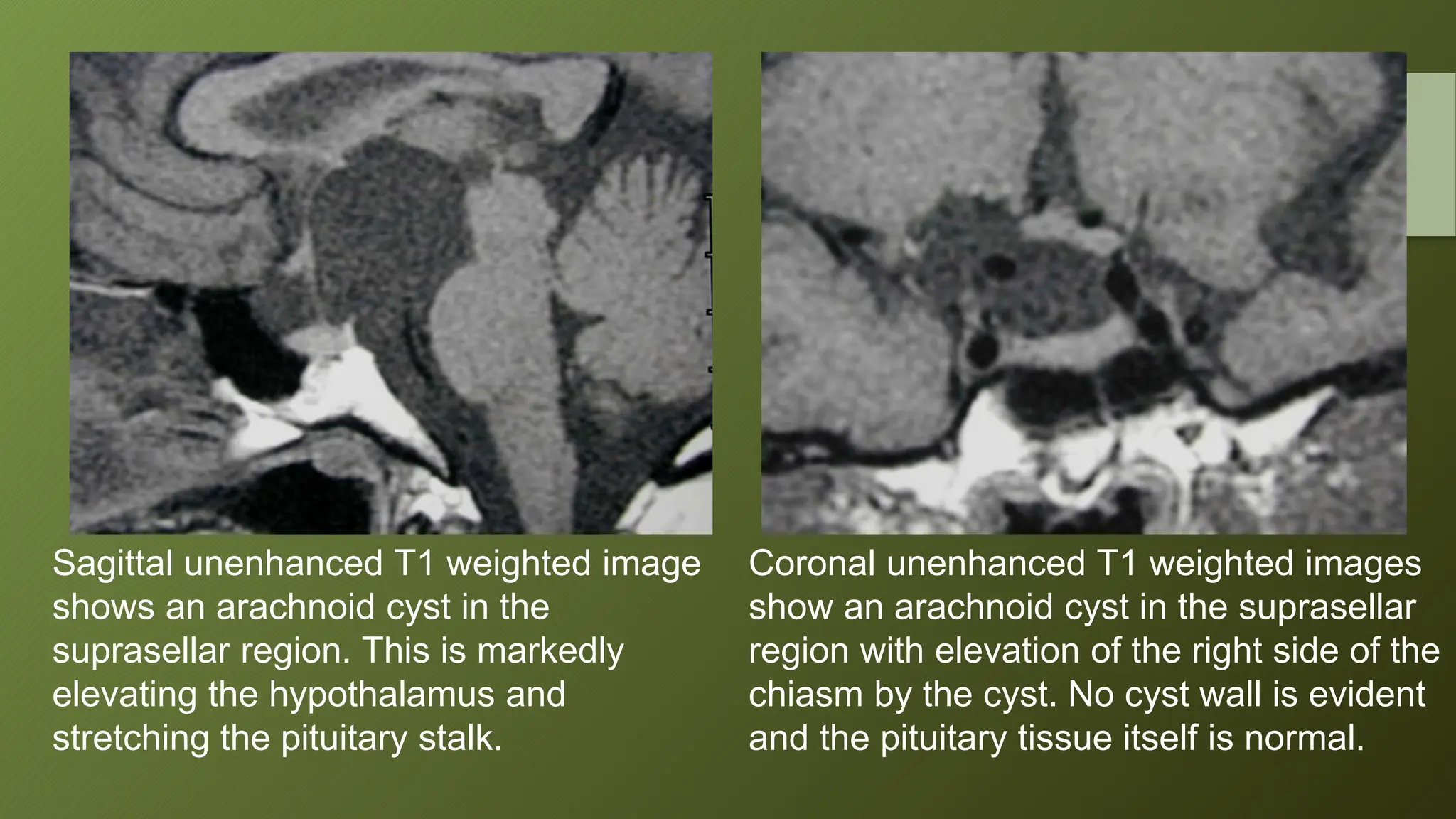 Pituitary gland MRI | PPTX