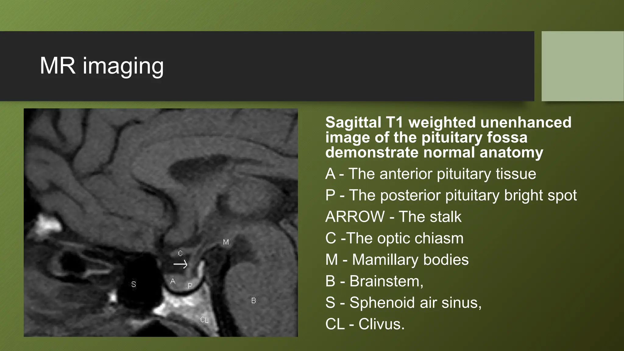 Pituitary gland MRI | PPTX