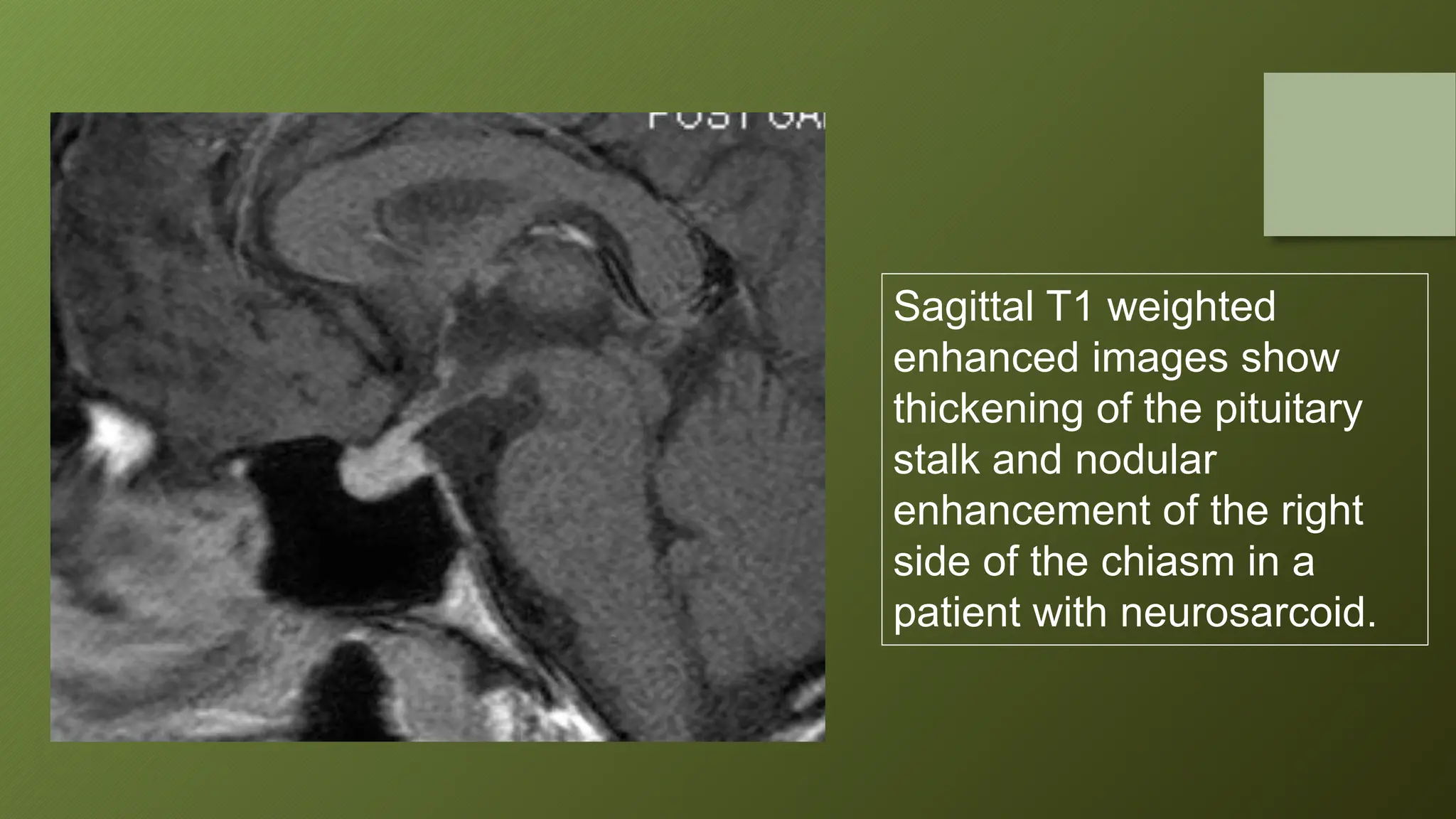 Pituitary gland MRI | PPTX