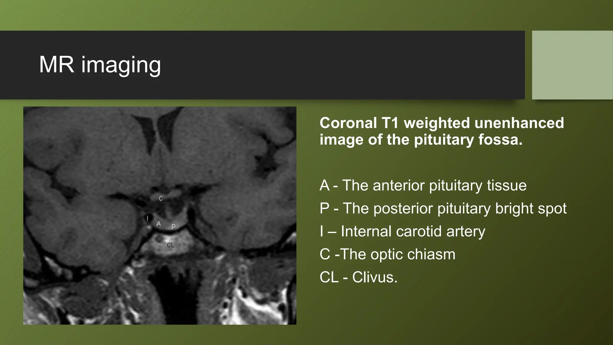Pituitary gland MRI | PPTX