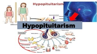 pituitary gland disorder, Hypopituitarism and Hyperpituitarism | PPTX
