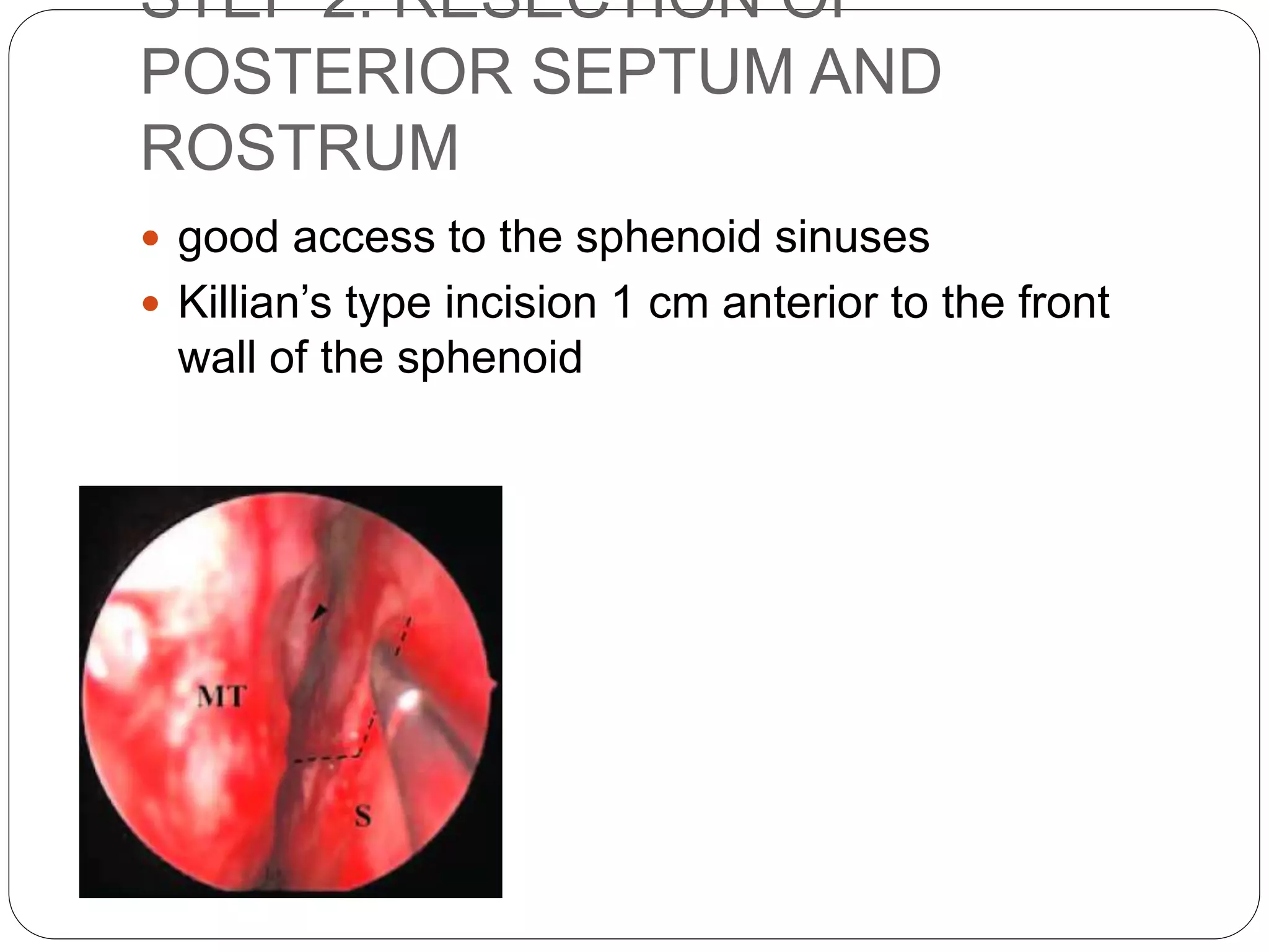 Pituitary surgery | PPTX
