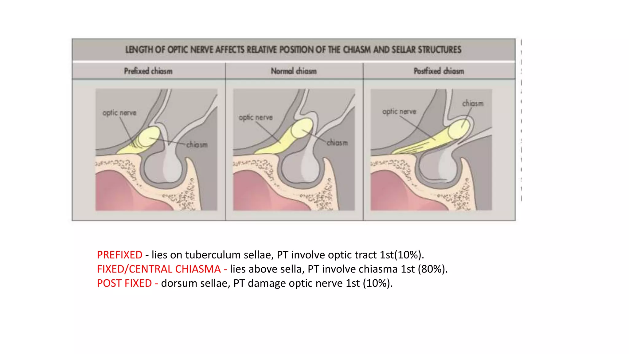 Pituitary tumors | PPTX