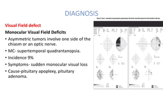 Pituitary tumors | PPT