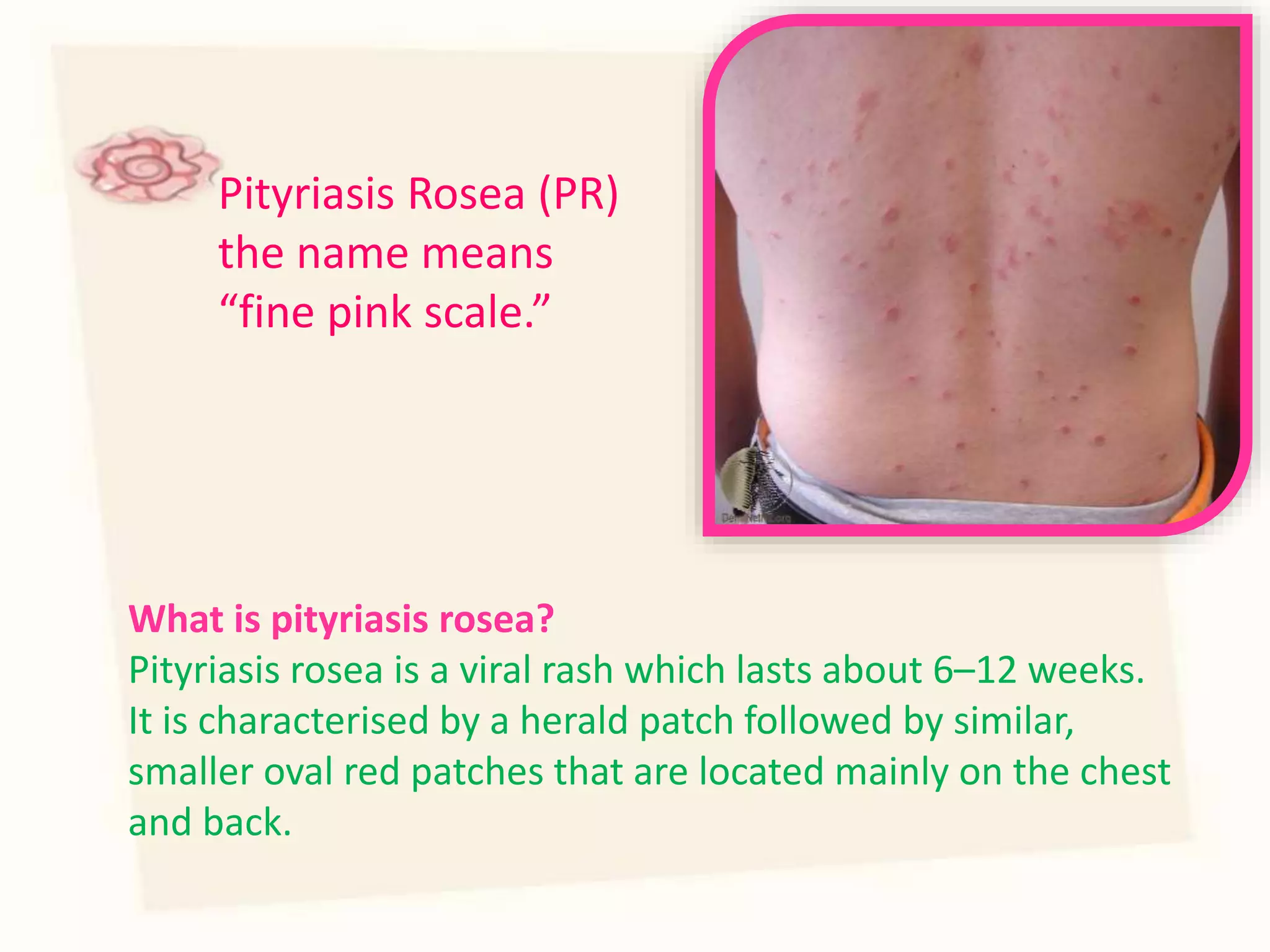 Pityriasis rosea | PPTX