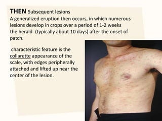 Pityriasis rosea | PPTX