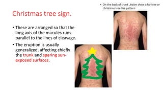 Pityriasis Rosea Christmas Tree