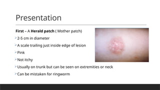 Pityriasis rosea dermatology small lecture.pptx