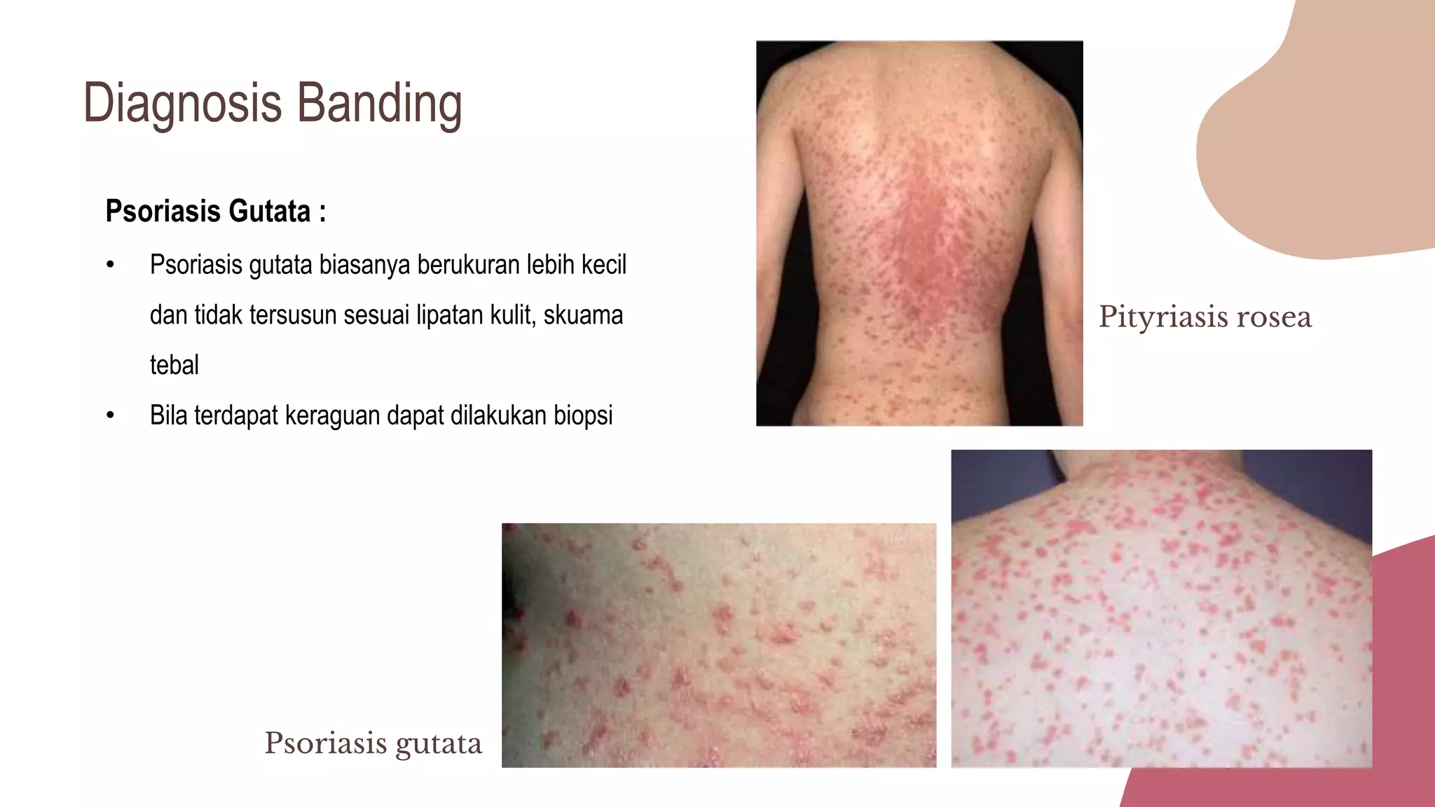 Pityriasis Rosea 210.pptx