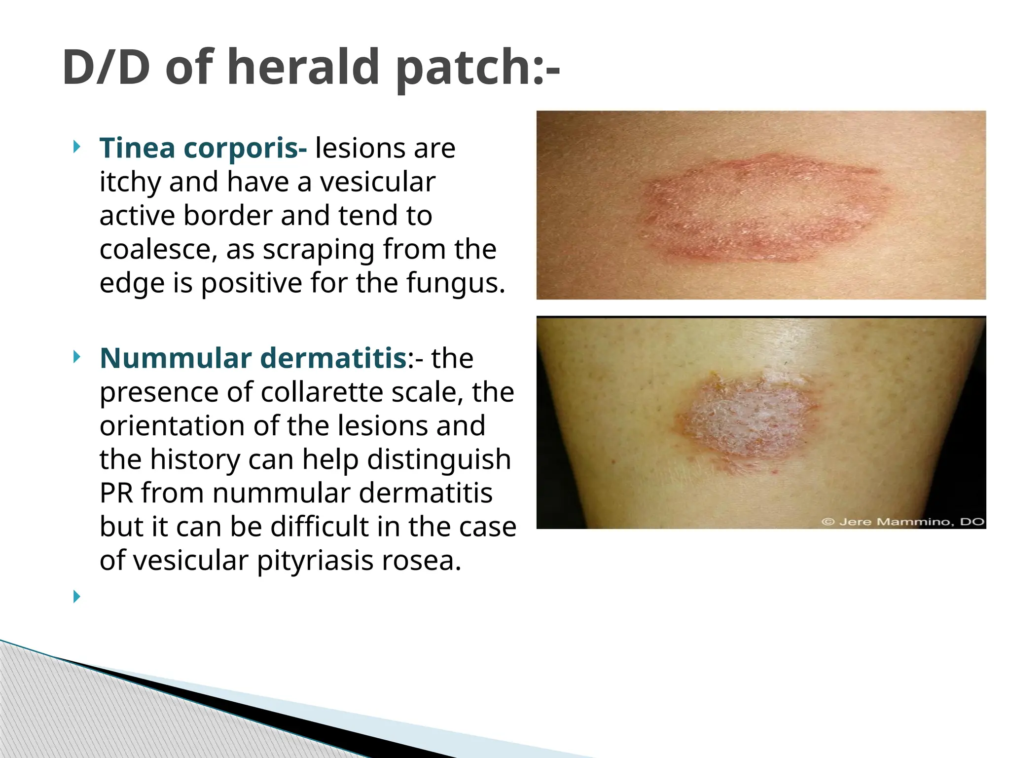 Pityriasis Rosea in dermatology and it's management | PPTX