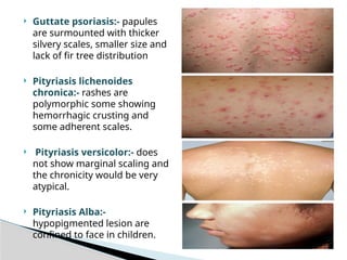 Pityriasis Rosea in dermatology and it's management | PPTX