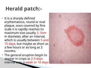 Pityriasis Rosea in dermatology and it's management | PPTX