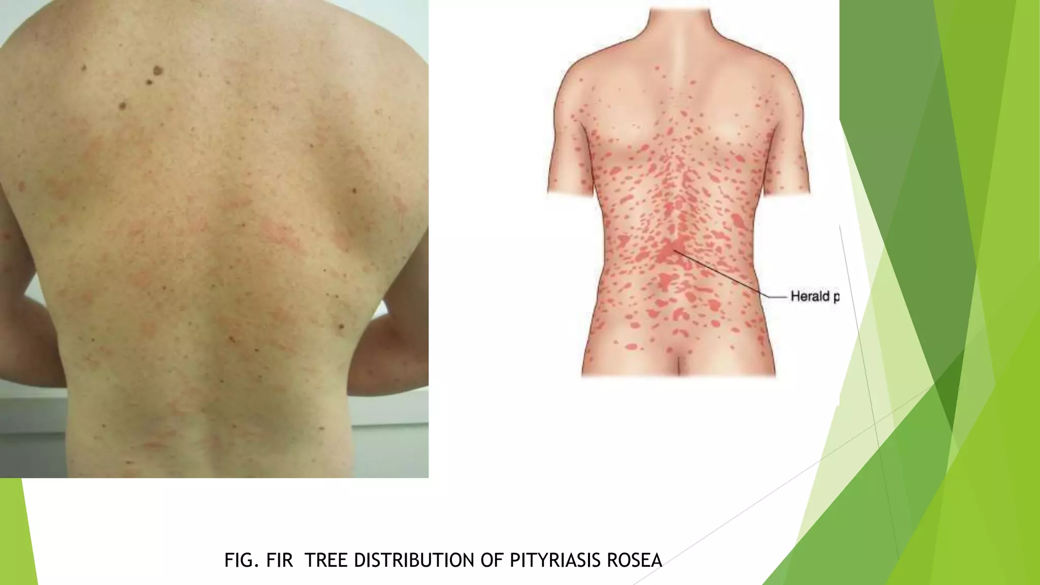 Pityriasis versicolor | PPTX