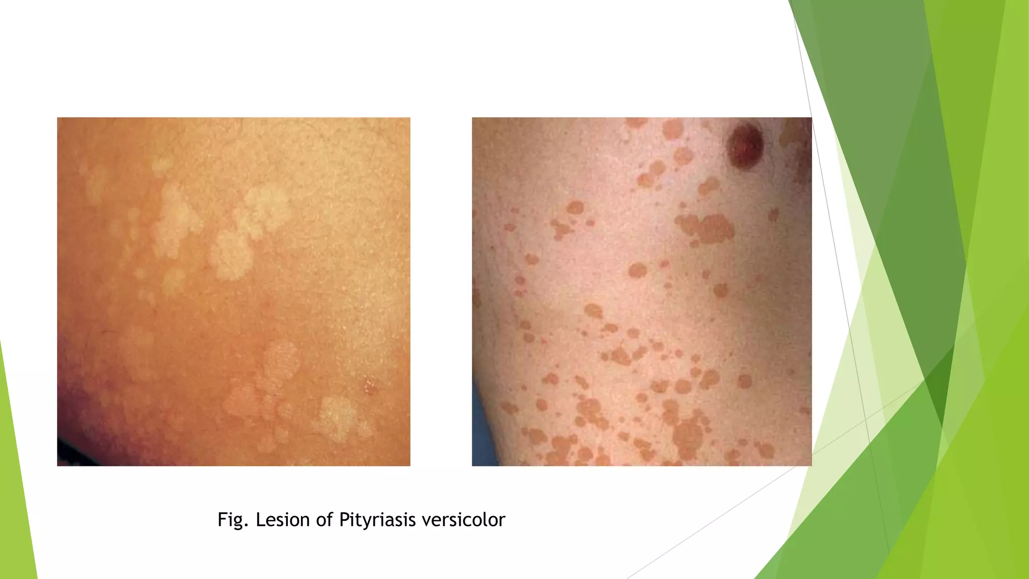 Pityriasis versicolor | PPTX