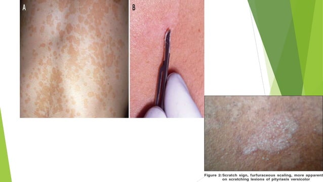 Pityriasis versicolor | PPTX | Skin and Dermatology | Diseases and ...