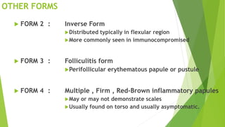 Pityriasis versicolor | PPTX