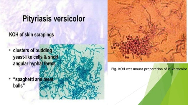 Pityriasis versicolor | PPT