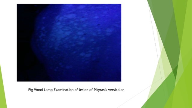 Pityriasis versicolor | PPTX | Skin and Dermatology | Diseases and ...