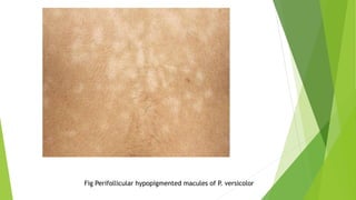 Pityriasis versicolor | PPTX