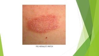 Pityriasis Versicolor