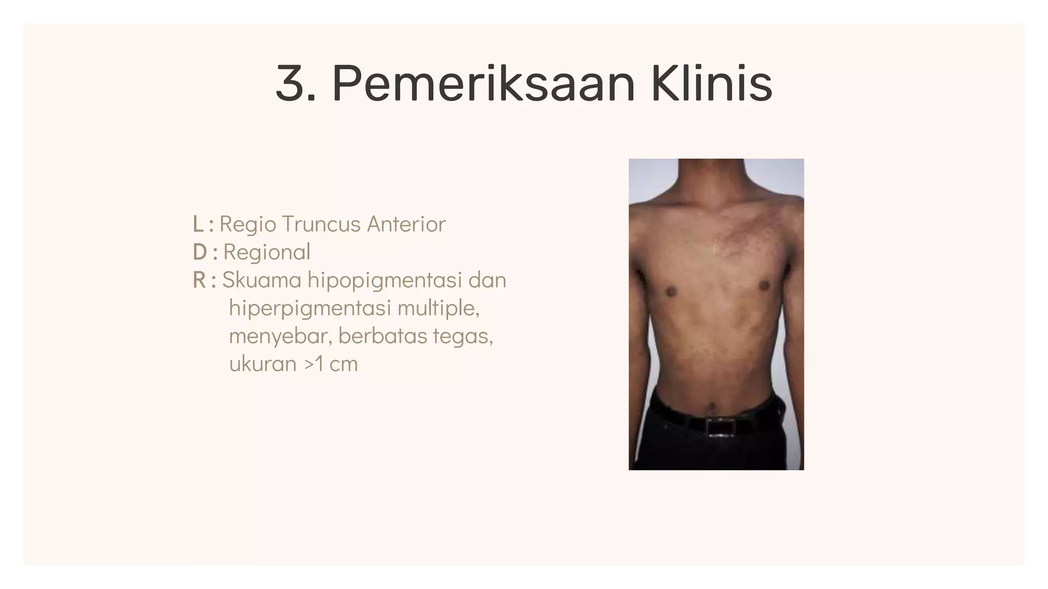 Laporan Kasus Tinea (Pityriasis) versicolor | PPTX