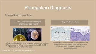 Laporan Kasus Tinea (Pityriasis) versicolor | PPTX