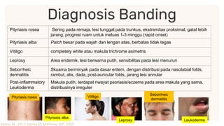 Laporan Kasus Tinea (Pityriasis) versicolor | PPTX