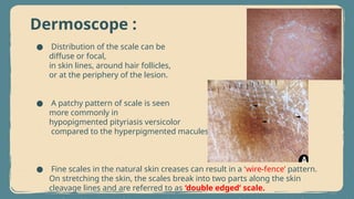 Pityriasis versicolor superficial fungal skin infection .pptx