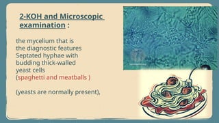 Pityriasis versicolor superficial fungal skin infection .pptx
