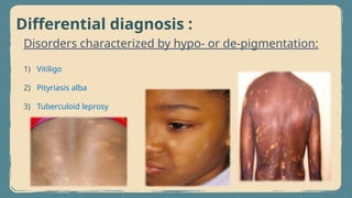 Pityriasis versicolor superficial fungal skin infection .pptx