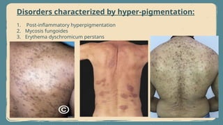 Pityriasis versicolor superficial fungal skin infection .pptx