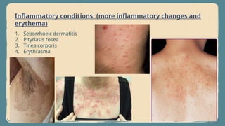 Pityriasis versicolor superficial fungal skin infection .pptx