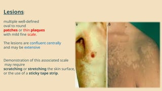 Pityriasis versicolor superficial fungal skin infection .pptx