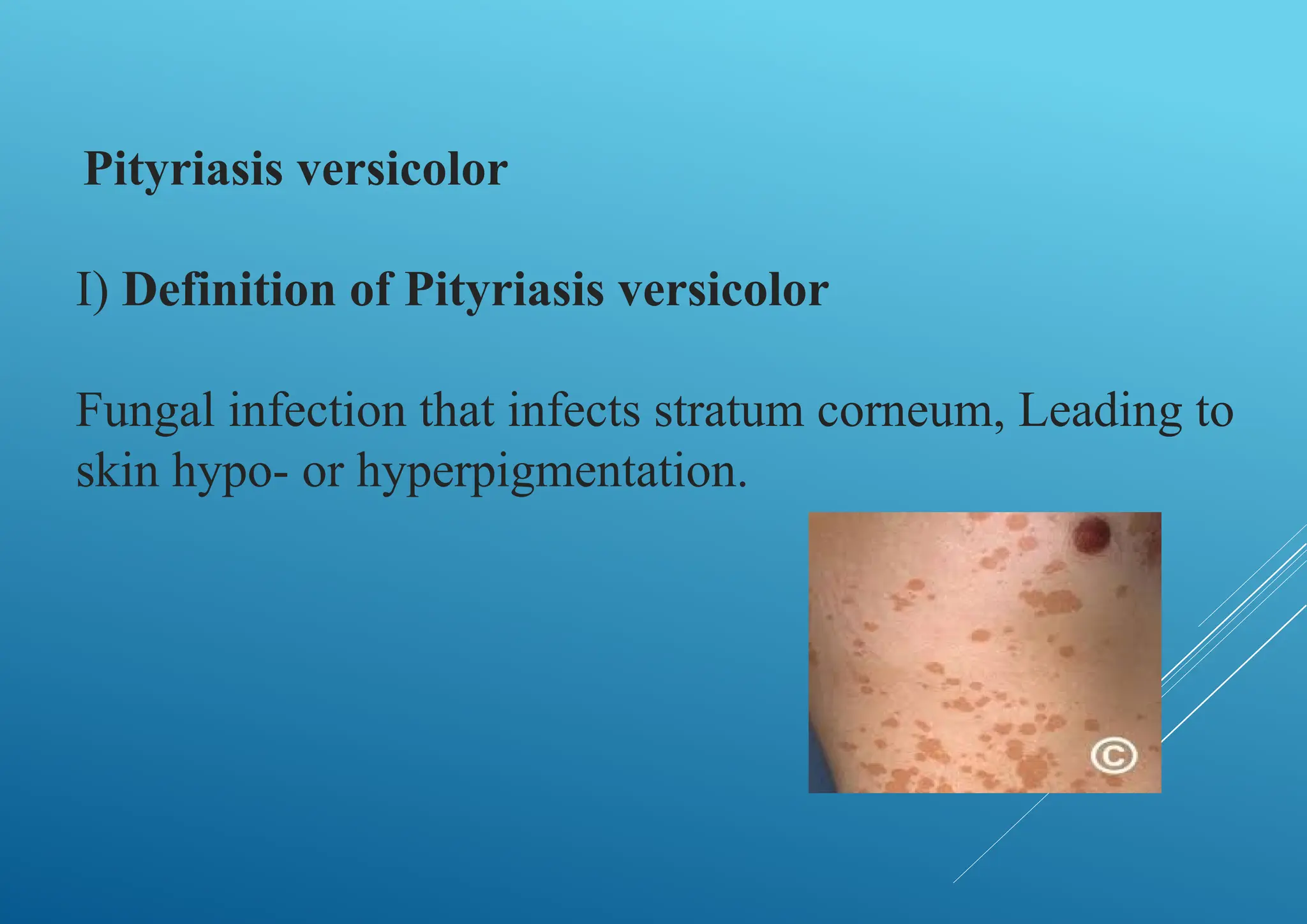 Pityriasis versicolor. For medical student | PPTX
